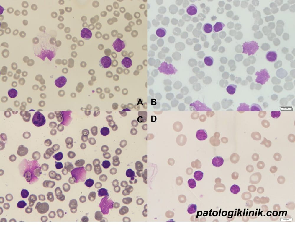 Menghitung Smudge Cells pada Pasien CLL